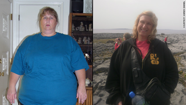 After losing 175 pounds, woman challenged by setback - CNN.com