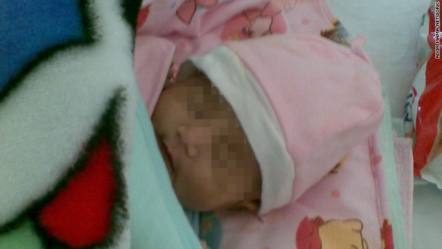 Chinese baby born with birth defect gets surgery - CNN.com